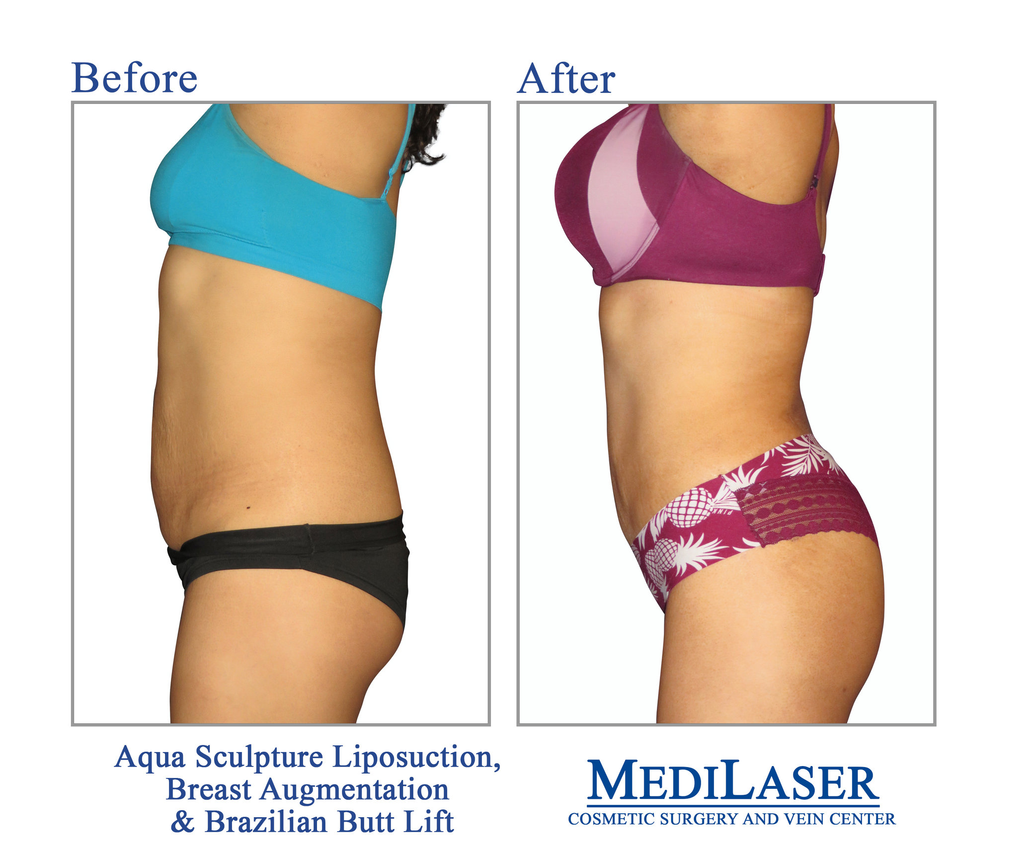 BBL Before & After | Medilaser | Frisco, TX