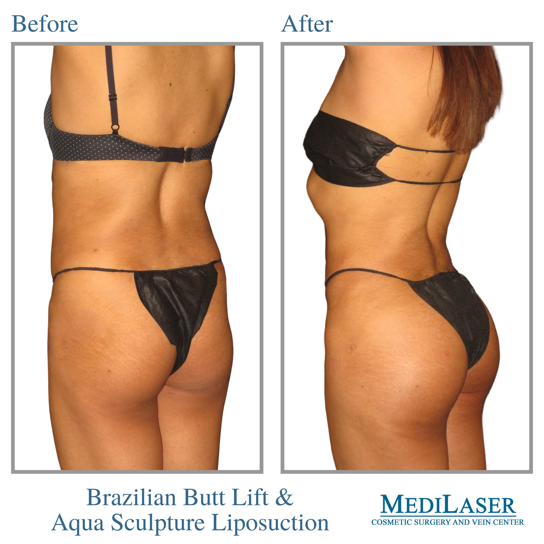 BBL Before & After | Medilaser | Frisco, TX